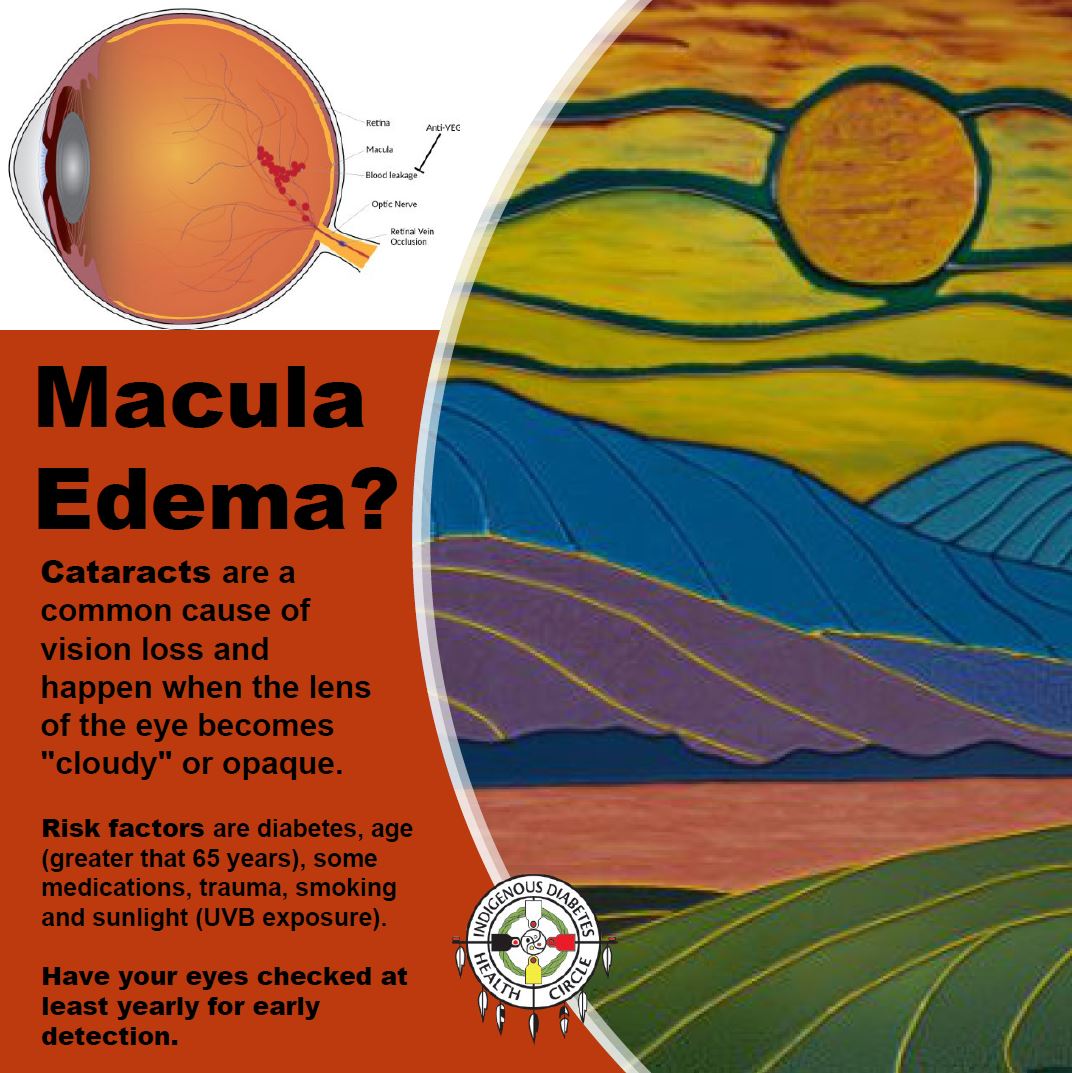 Macula Edema? – IDHC